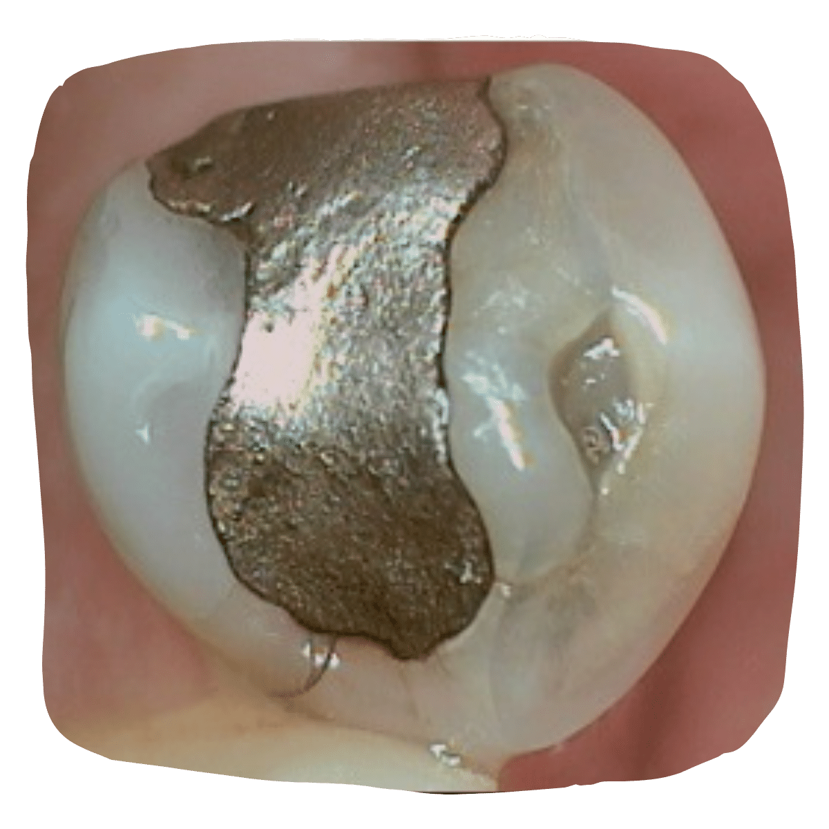 LUM Transillumination | Digital Doc #1 INTRAORAL CAMERA FOR DENTISTS